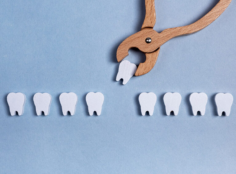 Tooth Extractions in SW Calgary | Tooth Extractions Near Me