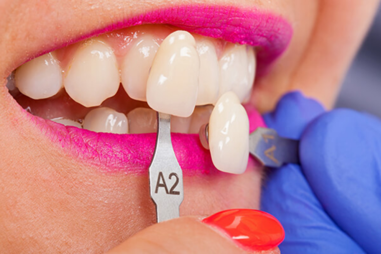 How Porcelain Veneers Can Fix Chips, Cracks, and Gaps